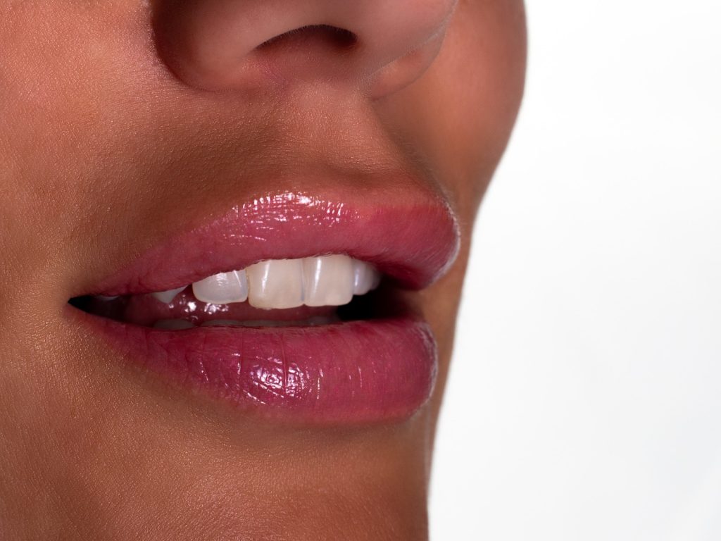 Ácido hialurónico en labios - Clínica dental Romeo: Dentistas en Vigo